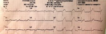 Wellens Syndrome • LITFL • ECG Library Eponym
