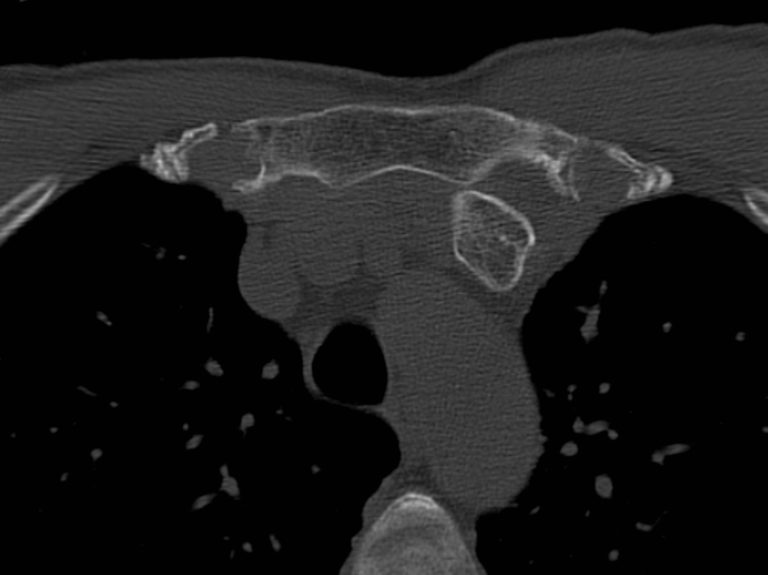 Sternoclavicular Joint Dislocation • LITFL • Trauma library