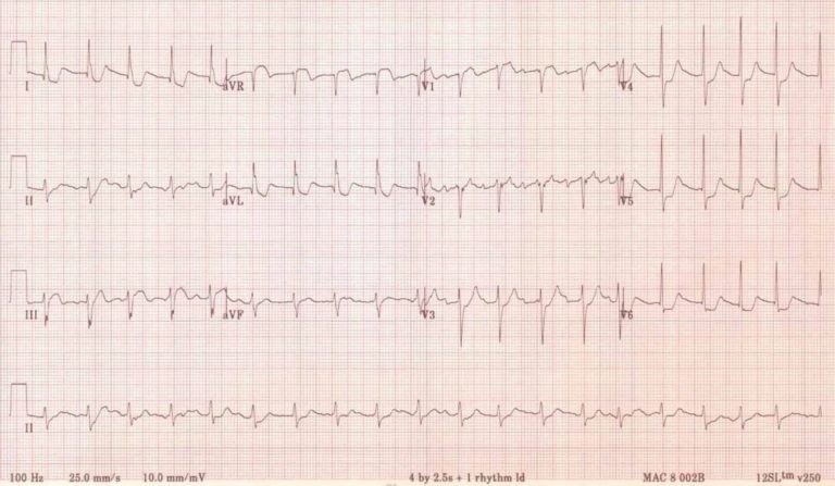 Another Widow Maker • LITFL • Clinical Cases ECG Exigency