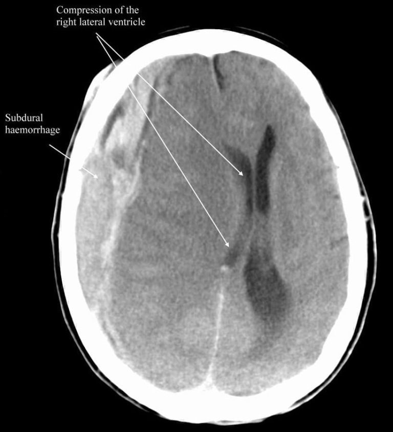 Trauma! Traumatic Brain Injury • LITFL • Trauma Tribulation