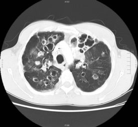 CXR Case 001 • LITFL • Chest X-ray Self-Assessment Quiz