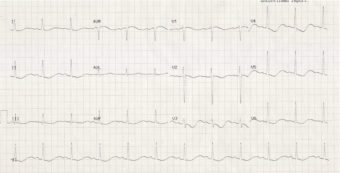 Metabolic Mayhem • LITFL • Clinical Cases ECG Exigency