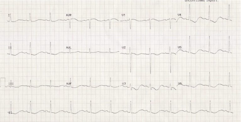 Metabolic Mayhem • LITFL • Clinical Cases ECG Exigency