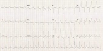 Metabolic Mayhem • LITFL • Clinical Cases ECG Exigency