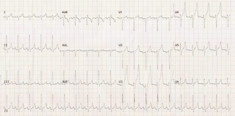 Metabolic Mayhem • LITFL • Clinical Cases ECG Exigency
