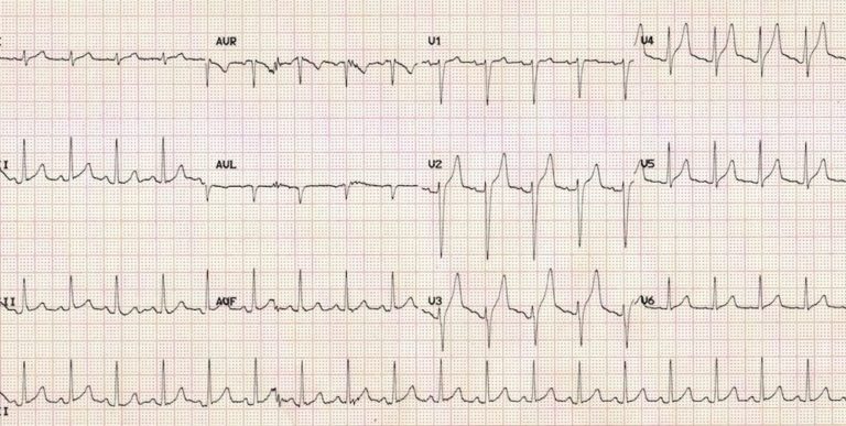 Metabolic Mayhem • LITFL • Clinical Cases ECG Exigency