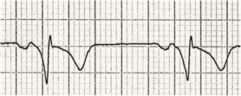 Delta Wave • LITFL Medical Blog • ECG Library Basics