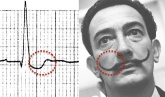 The ST Segment • LITFL • ECG Library Basics