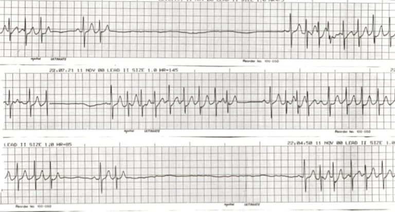 Risky Rhythyms • LITFL • Clinical Cases ECG Exigency