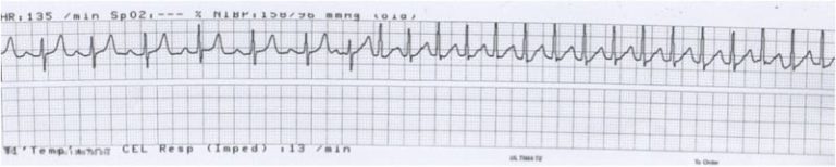 Risky Rhythyms • LITFL • Clinical Cases ECG Exigency