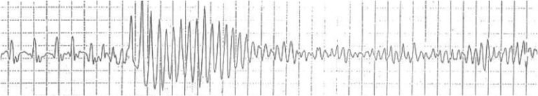 Risky Rhythyms • LITFL • Clinical Cases ECG Exigency