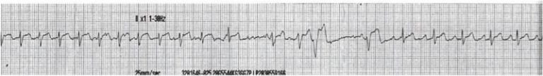 Risky Rhythyms • LITFL • Clinical Cases ECG Exigency