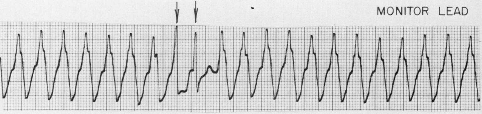 Dressler beat • LITFL • Medical Eponym Library