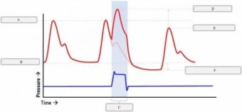 Intra-aortic Balloon Pump Trouble-shooting • LITFL • Curveball