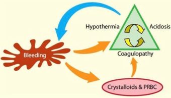 Trauma! Major Haemorrhage • LITFL • Trauma Tribulation