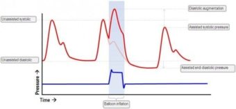 Intra-aortic Balloon Pump • LITFL • Clinical Cases Curveball