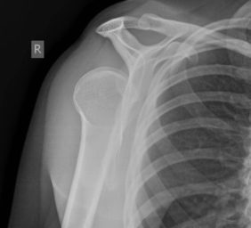 Posterior Shoulder Dislocation • LITFL • Trauma Library