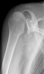 Posterior Shoulder Dislocation • LITFL • Trauma Library
