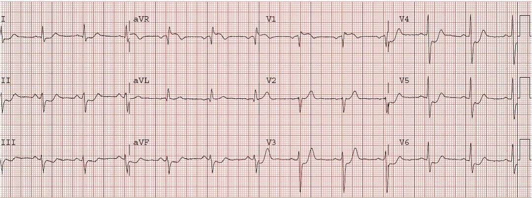 Shock, syncope and severe chest pain • LITFL • ECG Exigency