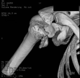 Posterior Shoulder Dislocation • LITFL • Trauma Library