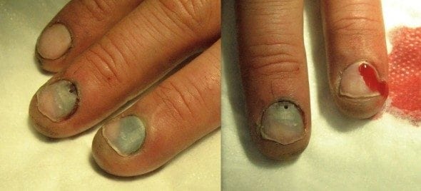 Subungual Hematoma Drainage