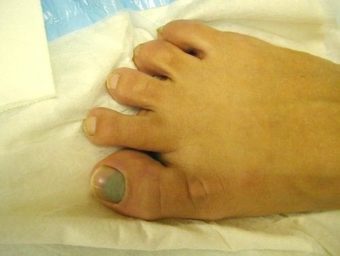 Subungual haematoma • LITFL • Clinical Cases Bamboozler