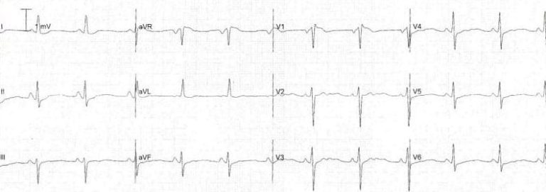 T wave • LITFL • ECG Library Basics