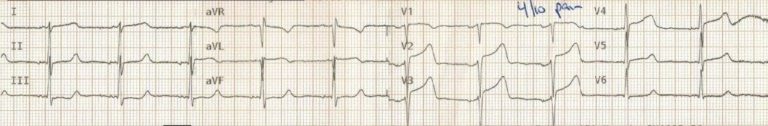 Wellens Syndrome • LITFL • ECG Library Eponym