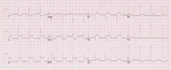ECG Case 001 • LITFL • ECG Top 100 Self-Assessment Quiz