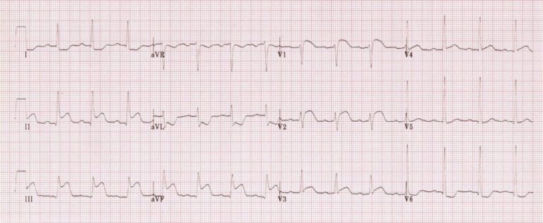 ECG Case 001 • LITFL • ECG Top 100 Self-Assessment Quiz