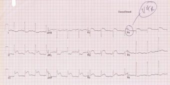 ECG Case 001 • LITFL • ECG Top 100 Self-Assessment Quiz