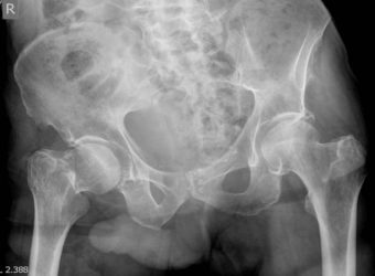 Tom Throckmorton • LITFL • Medical Eponym Library