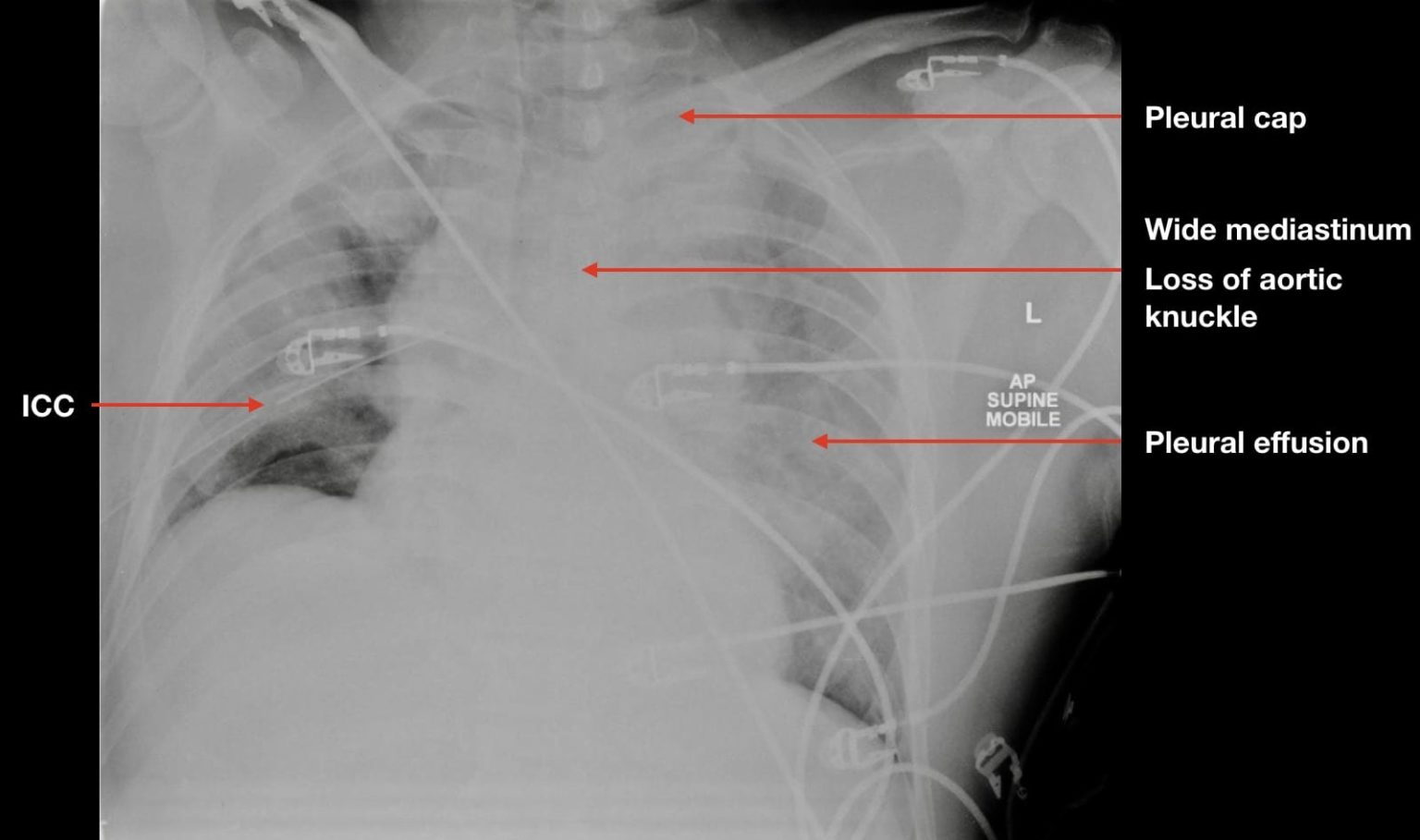 Trauma Under Pressure • LITFL • Trauma Tribulation