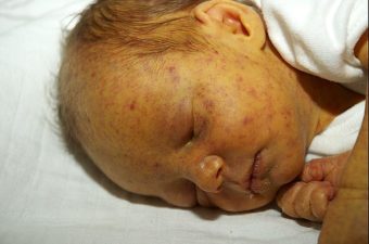 Perilous Pinhead Polka-dots • LITFL • Clinical Cases Paediatric