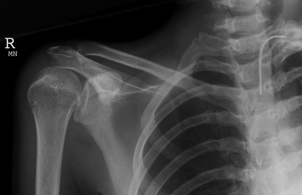 Posterior Shoulder Dislocation LITFL Trauma Library