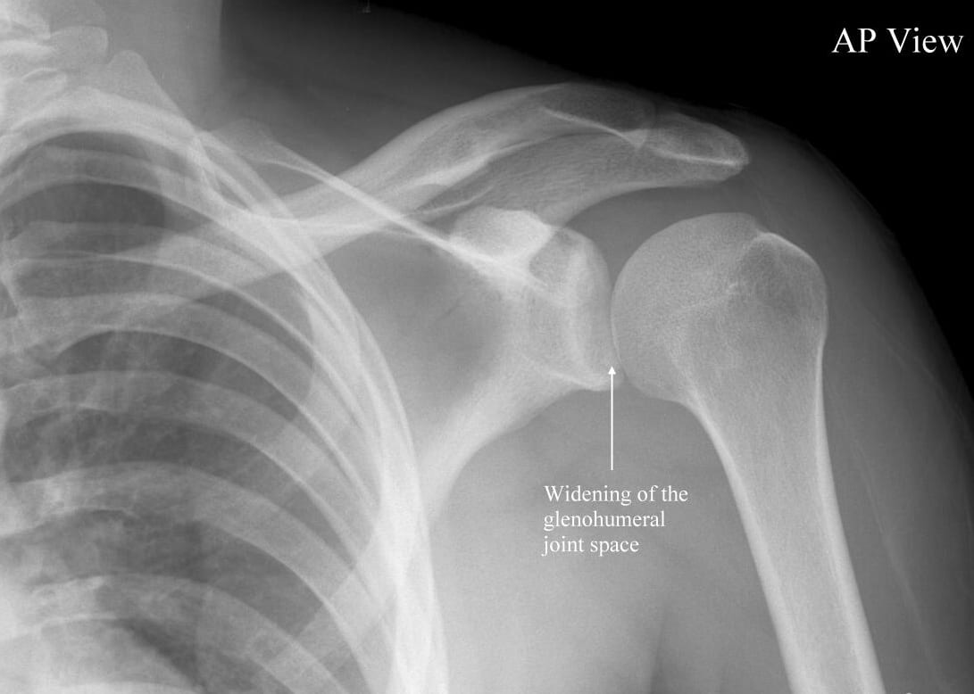 Posterior Shoulder Dislocation LITFL Trauma Library Posterior Shoulder Dislocation LITFL Trauma Library