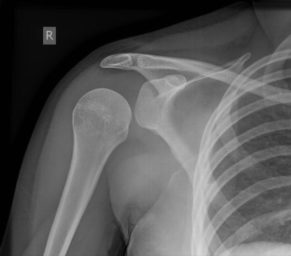 Posterior Shoulder Dislocation • LITFL • Trauma Library