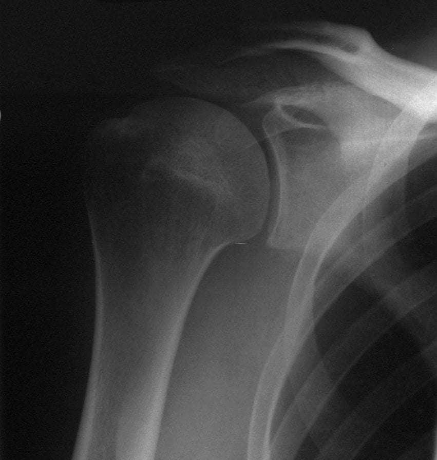 Posterior Shoulder Dislocation LITFL Trauma Library