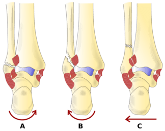 Danis-Weber classification • LITFL • Medical Eponym Library