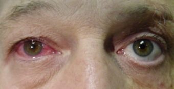 The Aching Red Photophobic Eye • LITFL • Ophthalmology Befuddler
