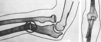 Bado Classification • LITFL • Medical Eponym Library