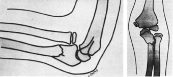 Bado Classification • LITFL • Medical Eponym Library