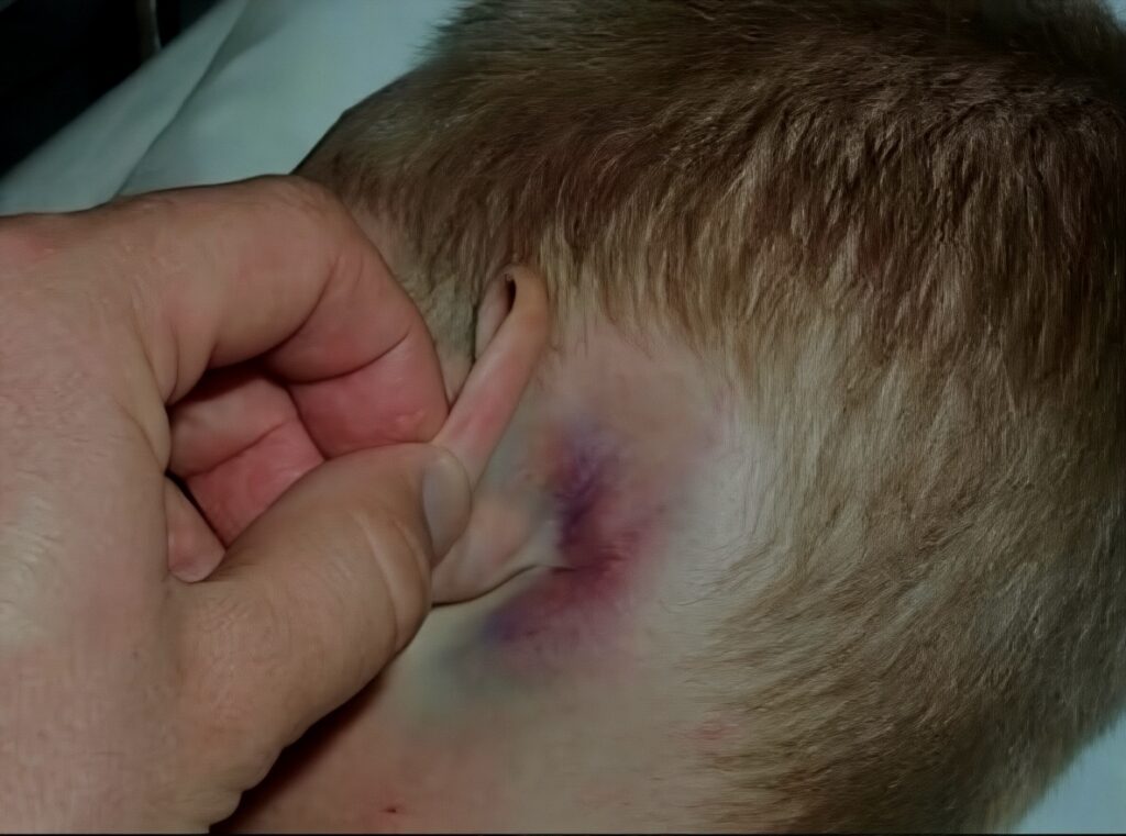 Battle Sign • LITFL • Medical Eponym Library