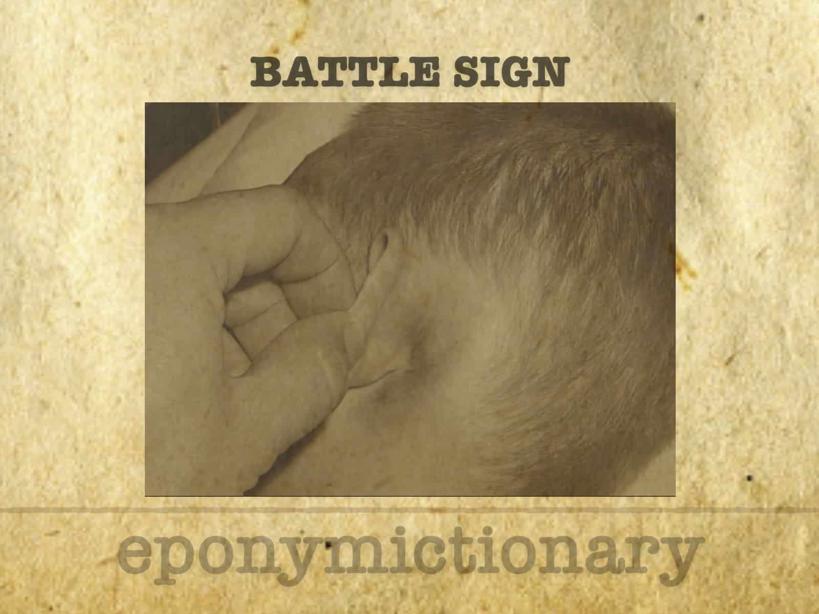 basilar skull fracture Archives • LITFL