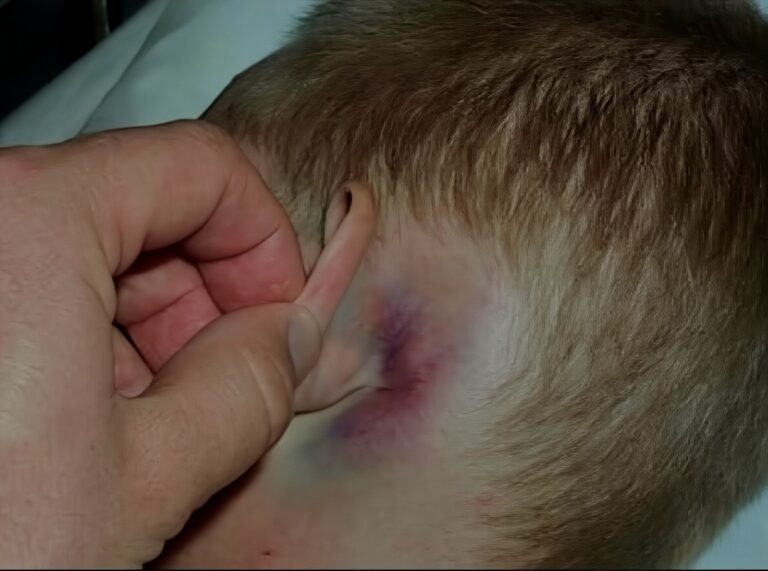 Battle Sign • LITFL • Medical Eponym Library