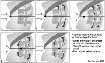 Chance fracture • LITFL Medical Blog • Medical Eponym Library