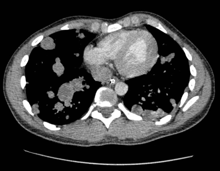 Cannon Balls • LITFL • Oncological Quandary