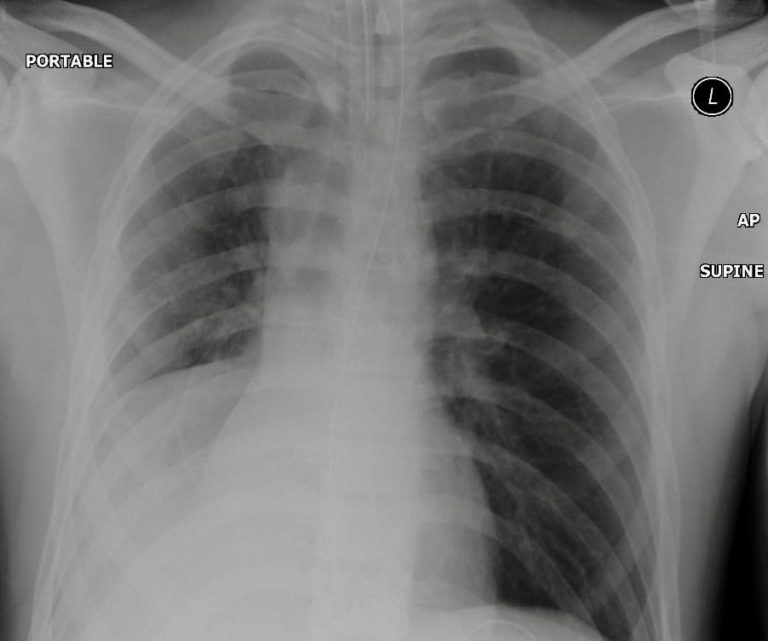 Collapse and recruit • LITFL • Pulmonary Puzzler