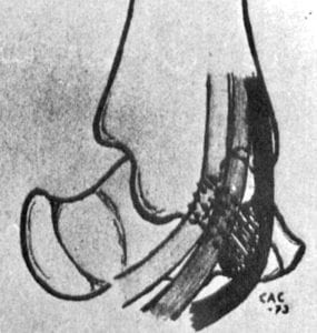 ankle fracture Archives • Page 3 of 5 • Life in the Fast Lane • LITFL ...