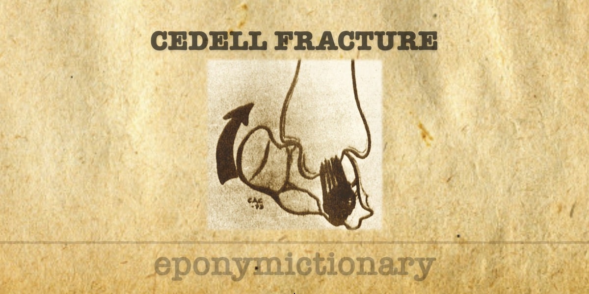 Cedell fracture • LITFL • Medical Eponym Library